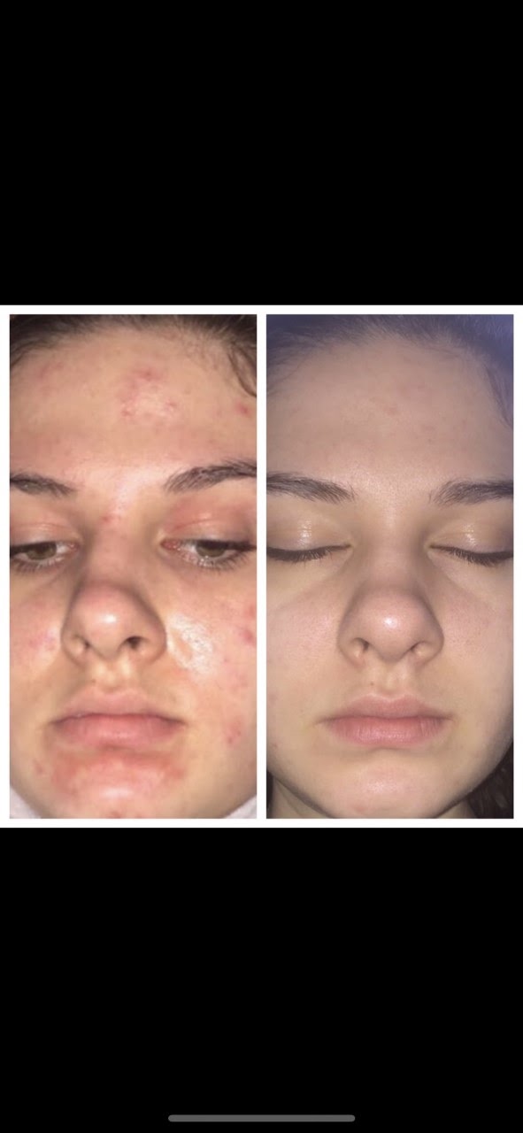 Can CBD Help Treat Acne? - Cannabis News and Culture Magazine